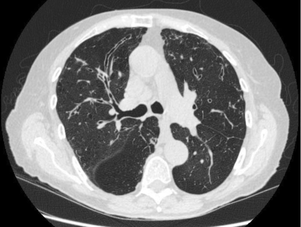 Bronchiectasis - Dr Ikbel Khalfallah